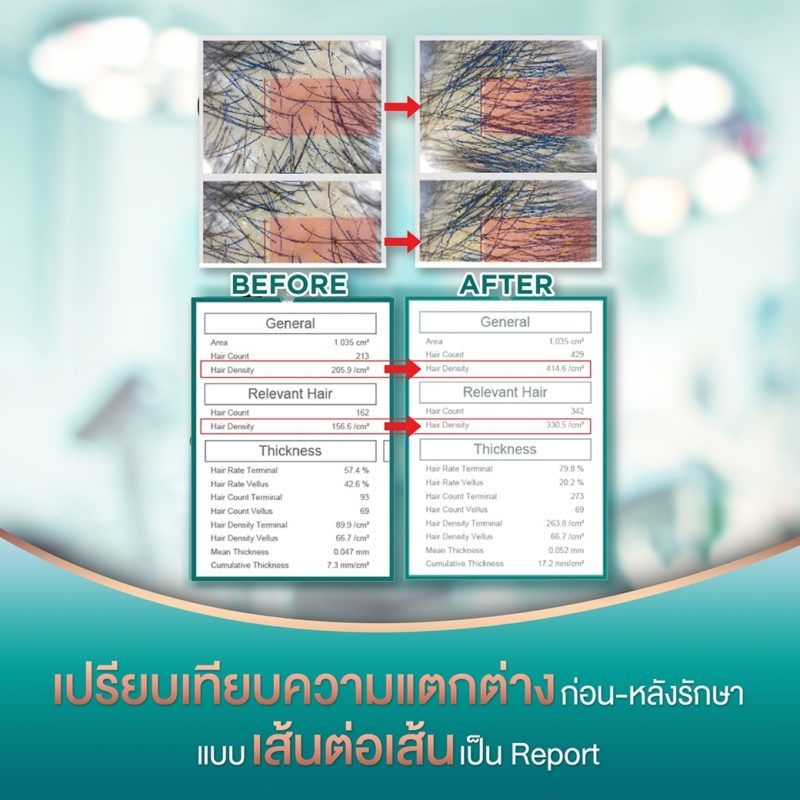 ปลูกผมด้วยเซลล์คุณเอง UR Cell Hair Micro Transplant+ เทคนิคใหม่!